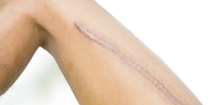 Can Red Light Therapy Help with Scars, Such as Keloids? - Best Red ...